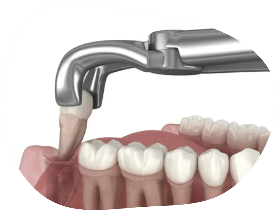 Vađenje umnjaka - Stomatološka ordinacija spec. dr Strahinja Ilić